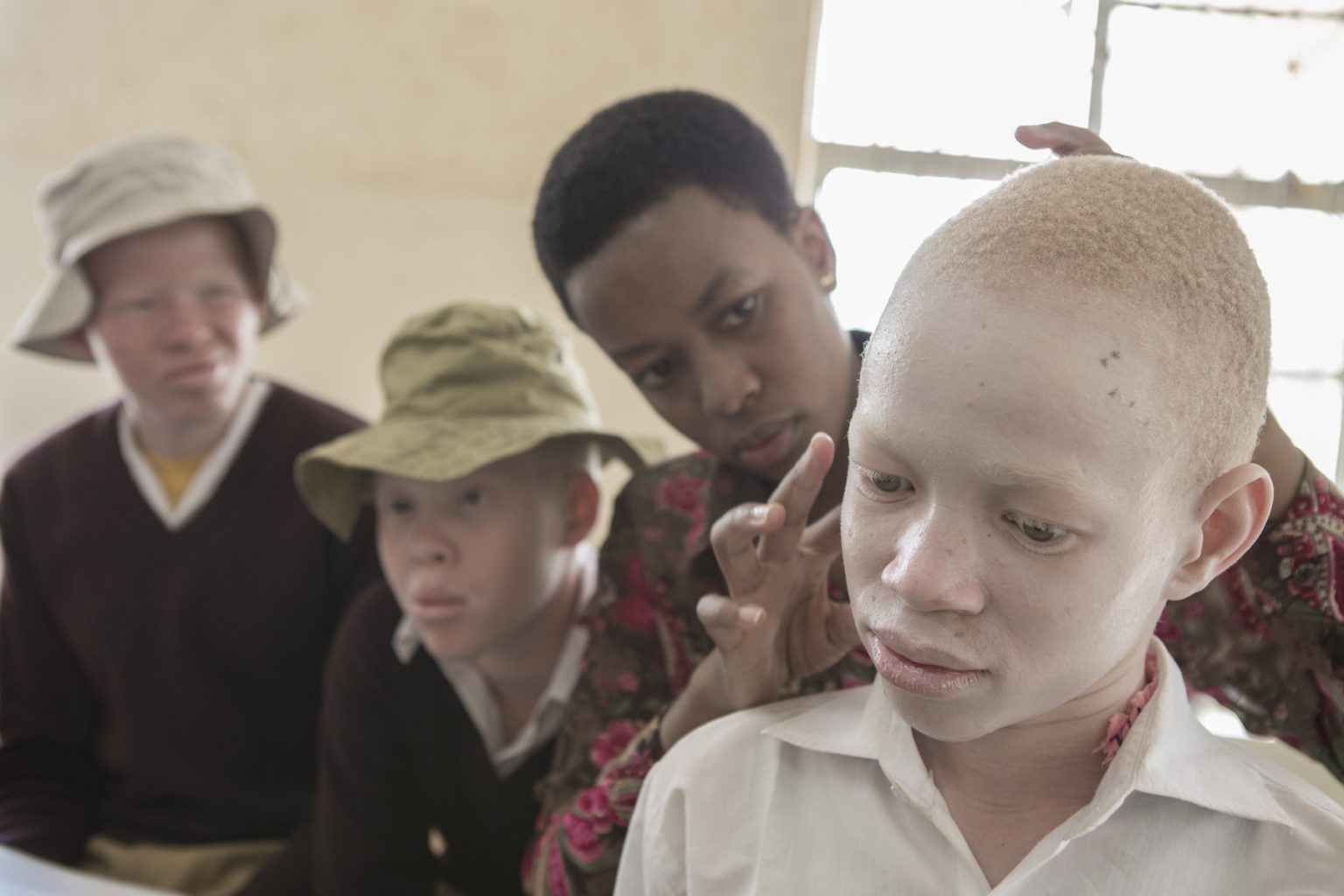 10 things you may not know about albinism - Beyond suncare